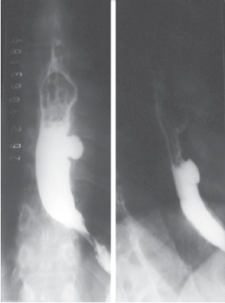 DIVERTÍCULO ESOFÁGICO [035 - 3] ~ RESUMIDA