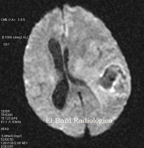 El Baúl Radiológico: 1) EDEMA VASOGÉNICO EN EL SISTEMA NERVIOSO CENTRAL ...