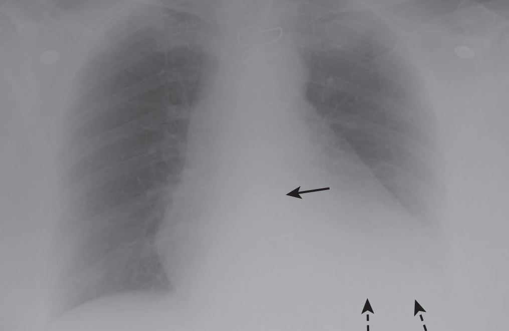 Reading chest radiograph - Penetration ~ Medicine Hack