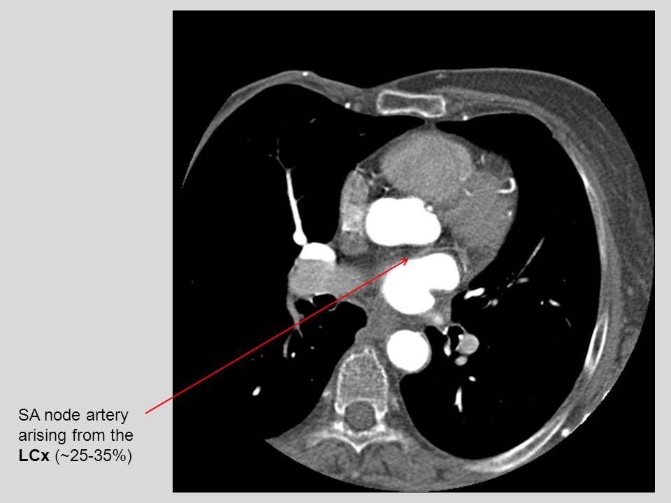 The Pump and the Tubes: The SA Node Artery