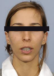 My Lingual Frenectomy and Orofacial Therapy: Why the Long Face?...