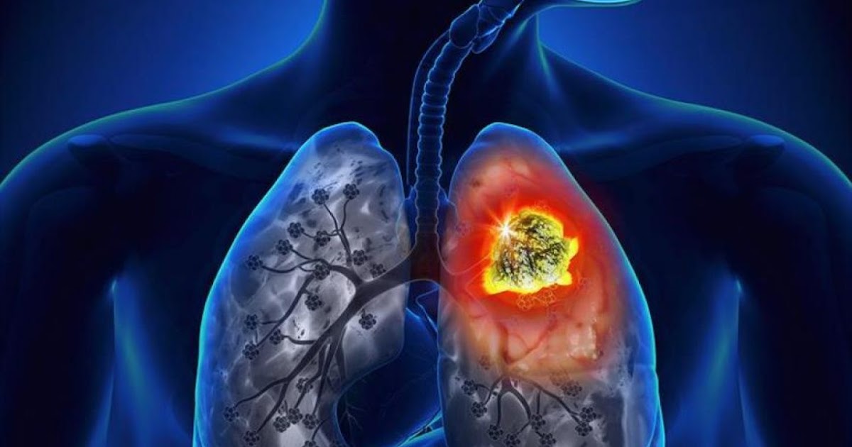 CÁNCER AL PULMÓN, CÁNCER SILENCIOSO