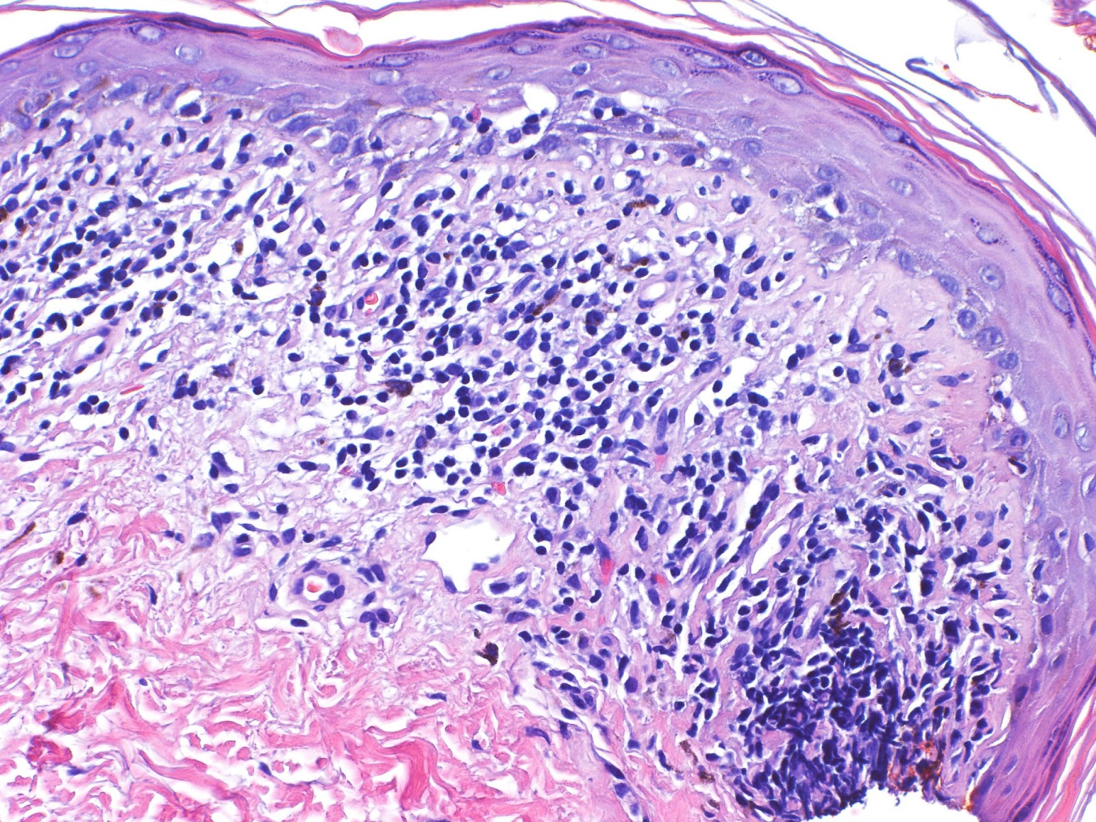 VIRTUAL GRAND ROUNDS IN DERMATOLOGY 2.0: A Case for Diagnosis