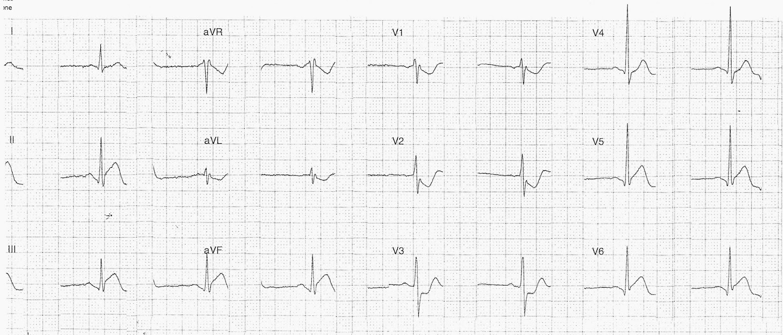ECG of the Week: ECG of the Week - 24th October 2016 - Interpretation