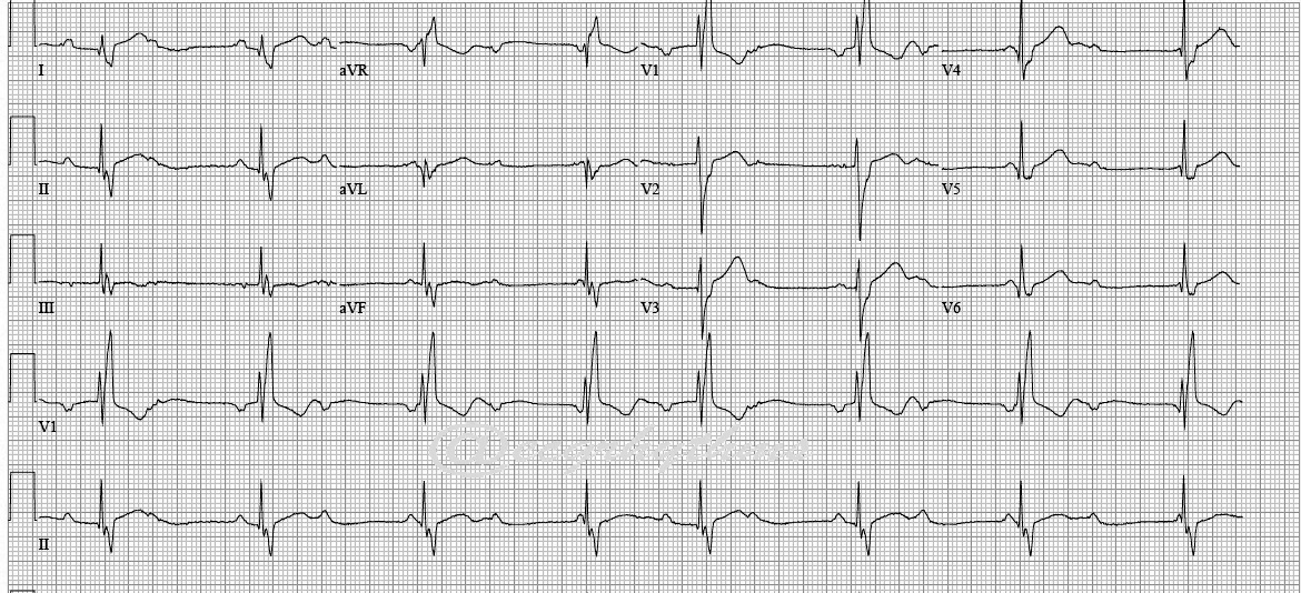 Ecg Rhythms Complete Heart Block Chb Think Again