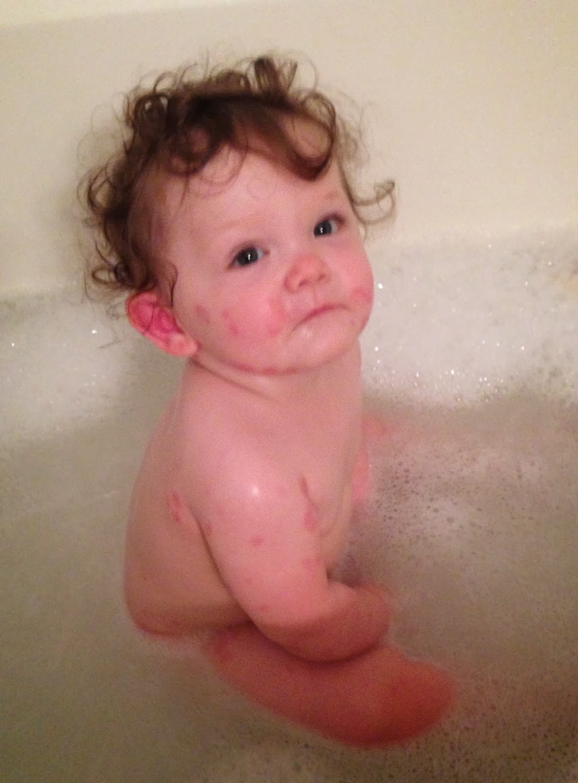 Peanut, The Littlest Beyer: You have a RASH?