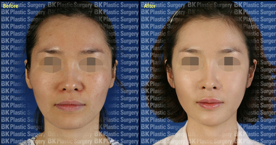 BK Plastic Surgery: [BK Plastic Surgery] 3D Cheekbone Reduction