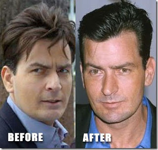 Charlie Sheen Hair Transplant