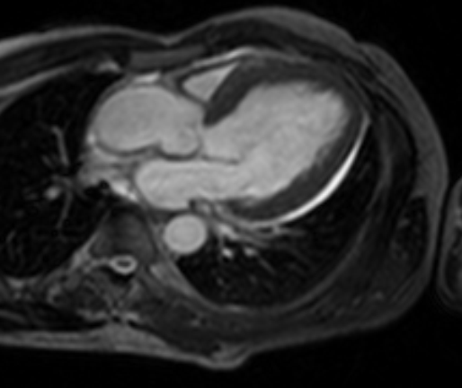 Left Ventricular Hypertrophy- Cardiac MRI - Sumer's Radiology Blog