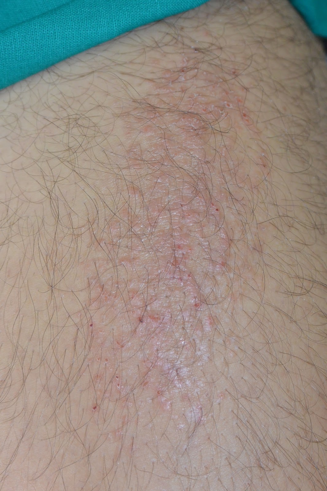 Derma-Docència Castelló: Un liquen (no tan) simple crónico...