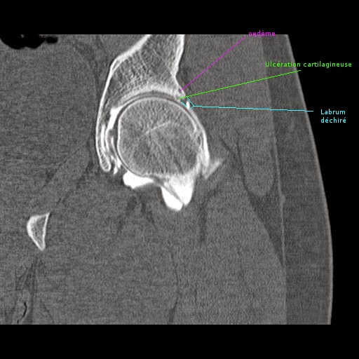 Conflit de Hanche: Imagerie du conflit de hanche