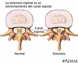 Enfermera en traumatología: Estenosis raquídea
