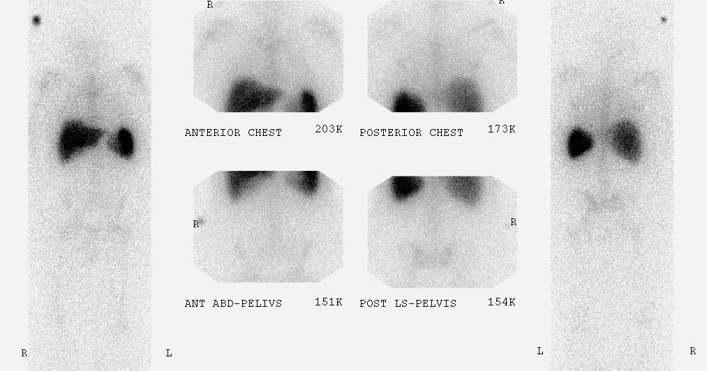 Nuclear medicine : Infection/Inflammation imaging with In-111 WBC scan ...