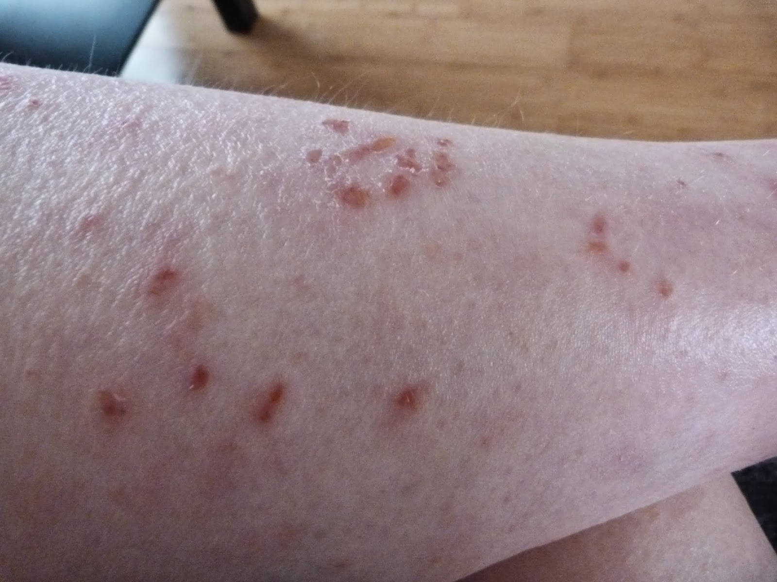 I Have Eczema: Eczema & Dermatillomania