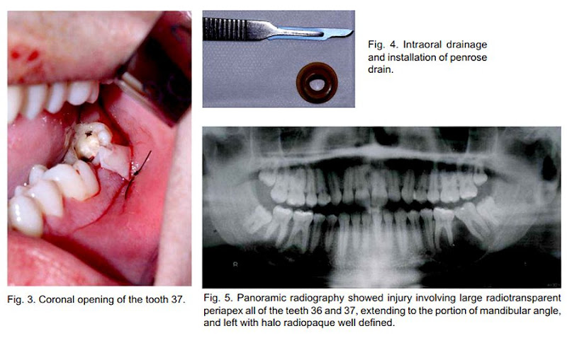 PDF: Odontogenic Keratocyst Tumor: Report of Two Cases