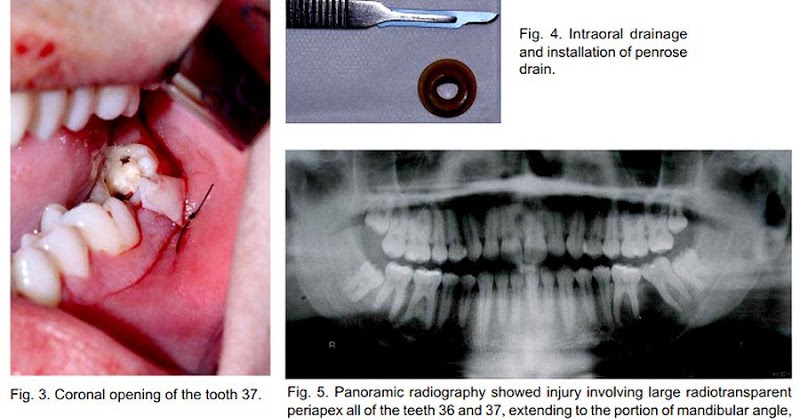 PDF: Odontogenic Keratocyst Tumor: Report of Two Cases - Ovi Dental