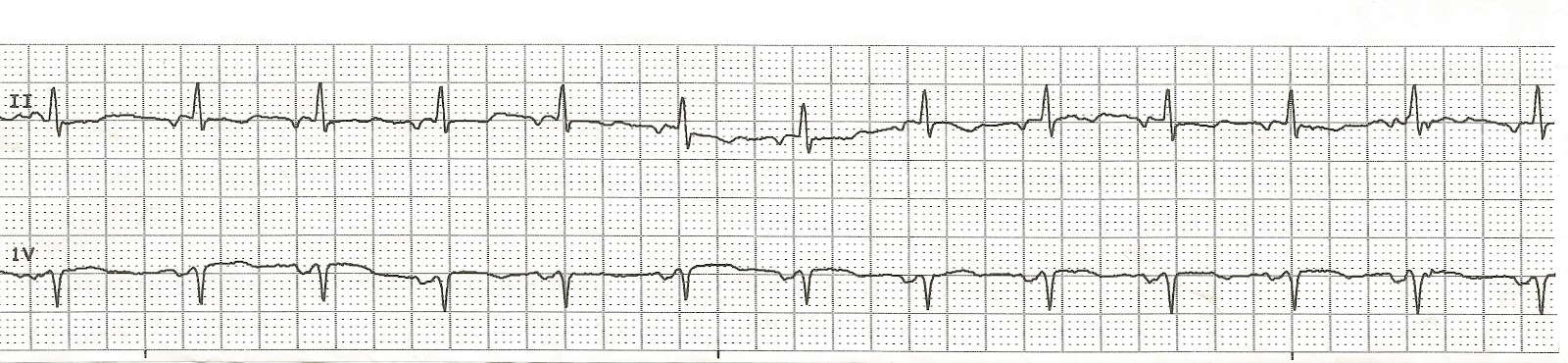 EKG Rhythm Strip Quiz 78