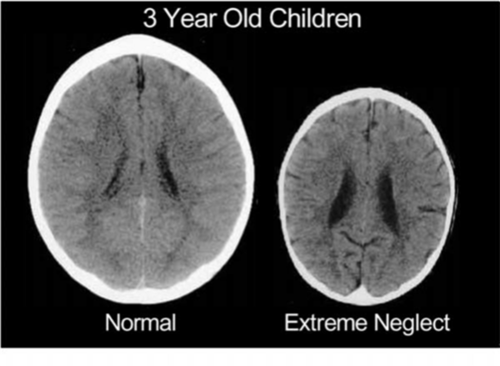 Child abuse in Aotearoa: The Implications On Brain Development.