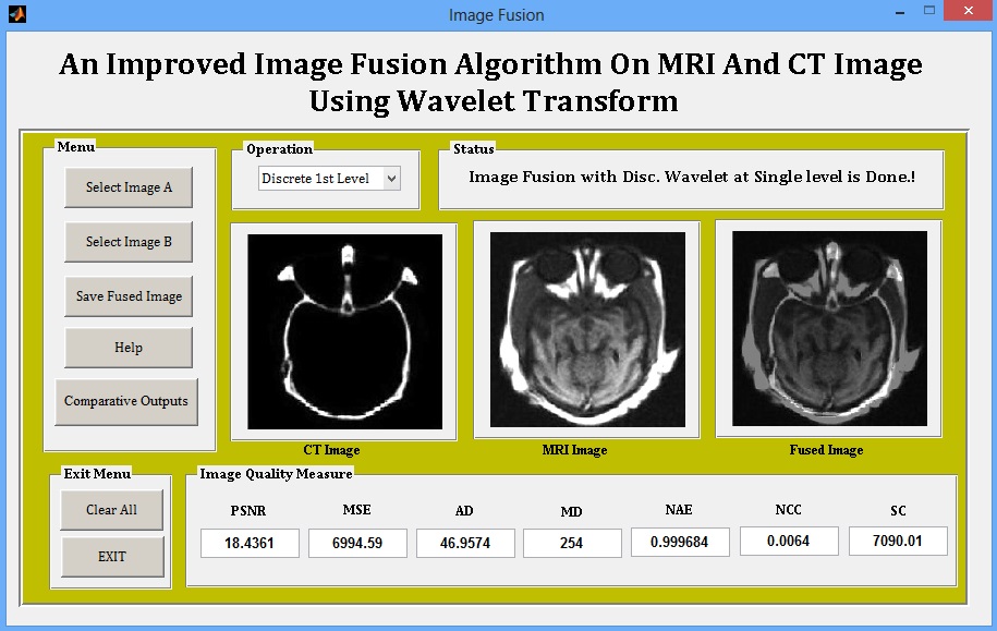 Image Fusion Algorithm On Mri And Ct Image Using Wavelet Transform Matlab Project With Source