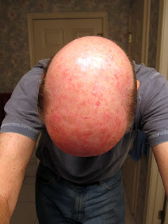 Efudex - Round Two: Day 9 - Starting to Feel the Burn