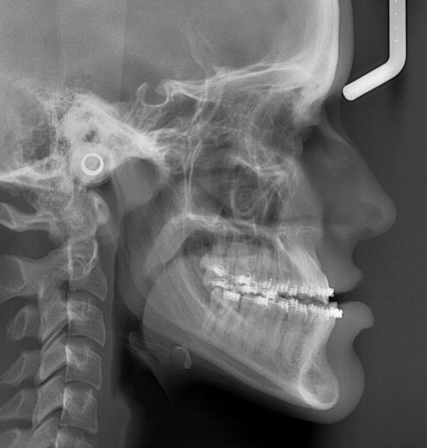Referência em Bucomaxilofacial no Espírito Santo: ANÁLISE CEFALOMÉTRICA ...