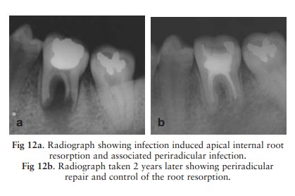 Endodontic: Internal inflammatory (infective) root resorption