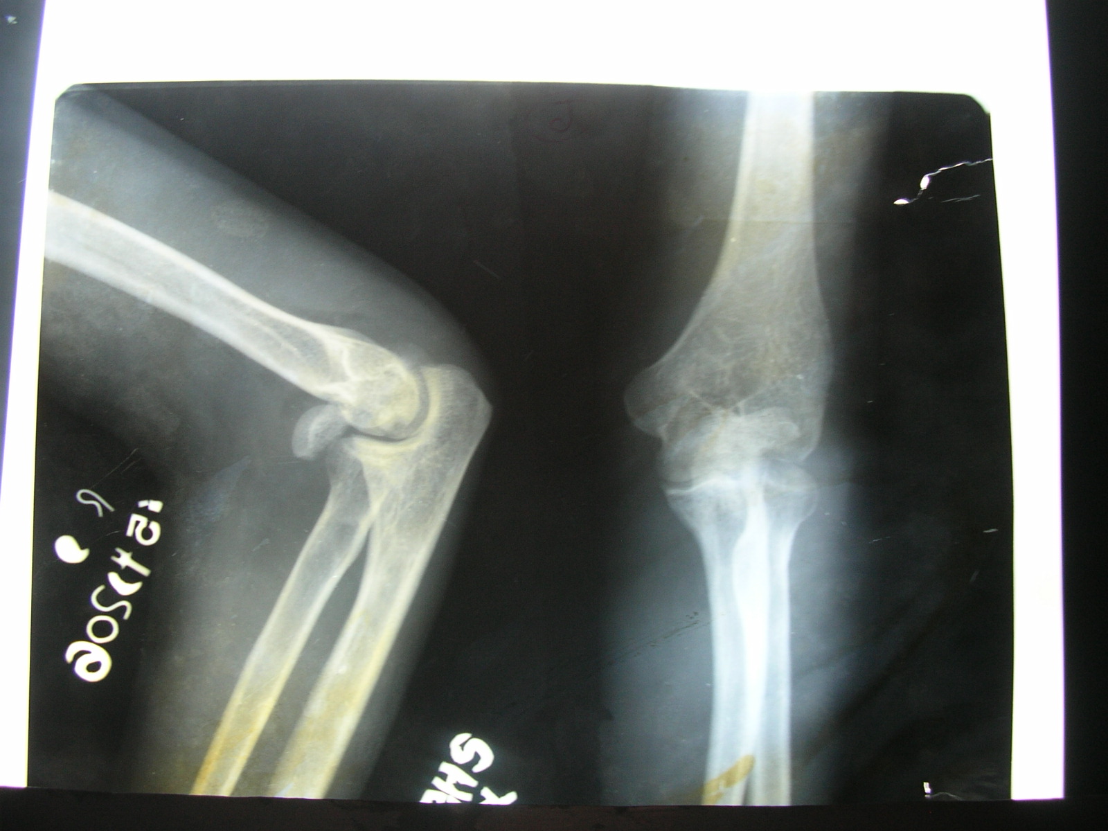 X-rays and Slides: fracture of lateral condyle of right humerus