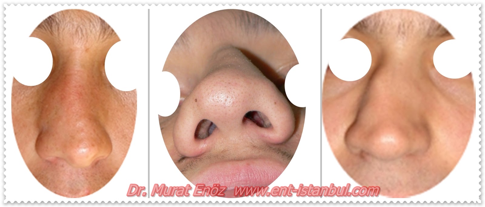 Nasal Fractures Causes Symptoms Diagnosis Treatment Atelier Yuwaciaojp