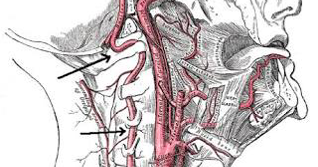 SÍNDROME DE WALLENBERG