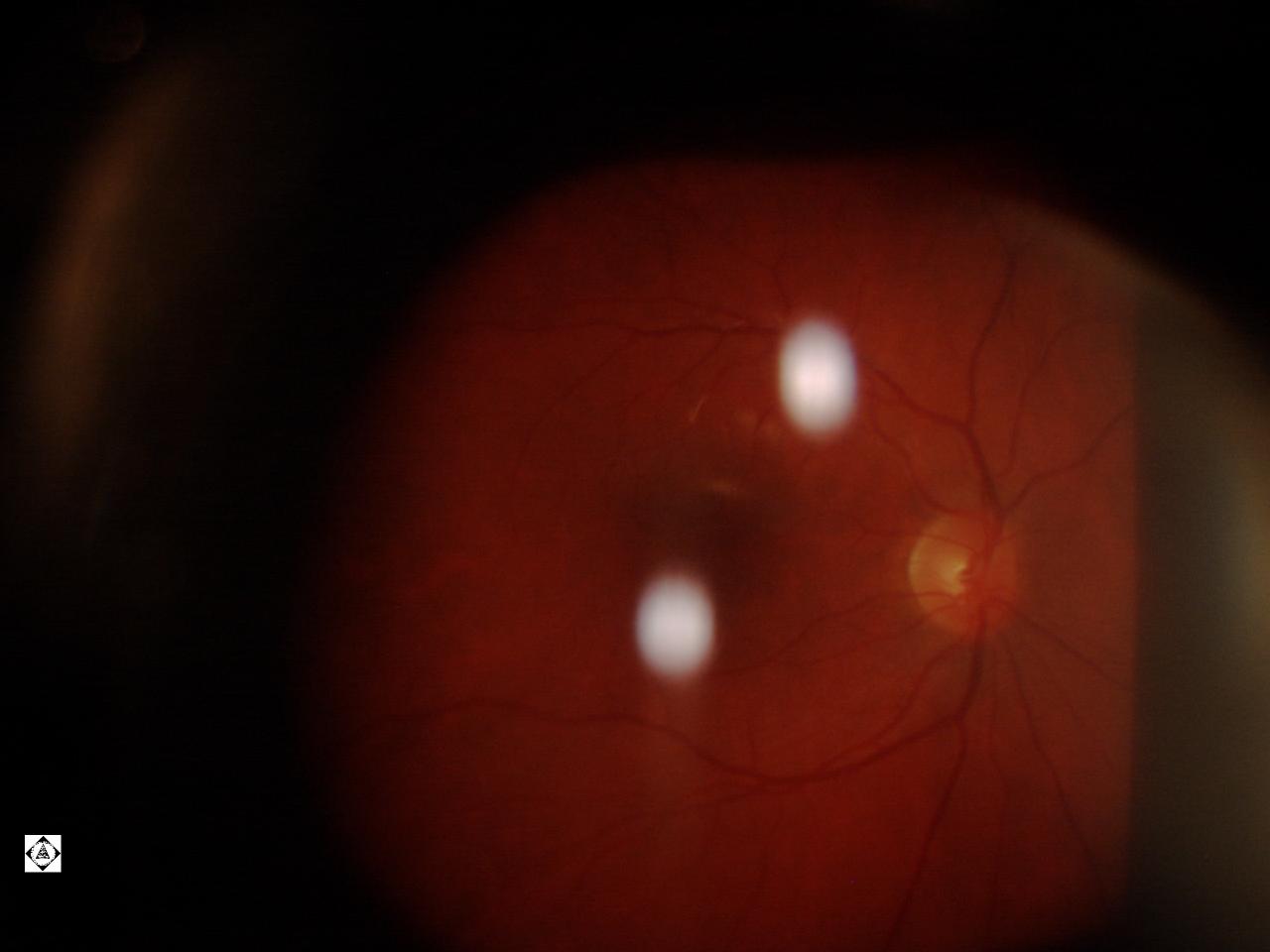 Sonoran Desert Eye Center: TORTUOUS RETINAL BLOOD VESSELS