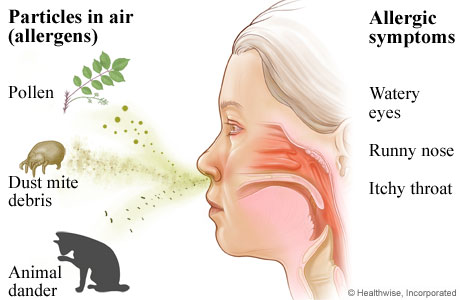 Health N Wealth: Allergy Symptoms – Raised Red Welts On Skin