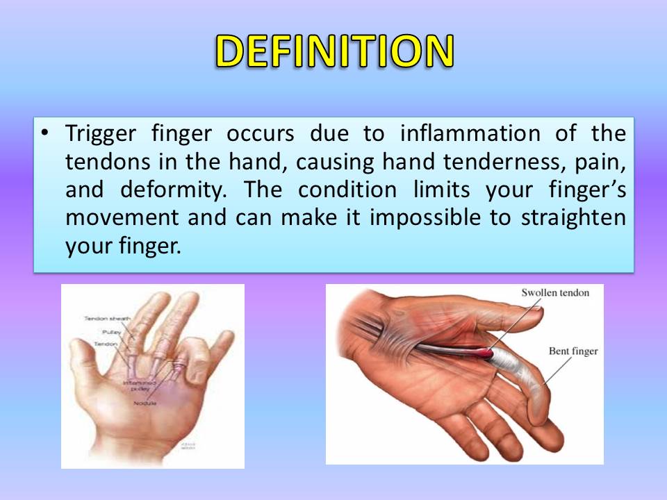 Trigger Finger Definition Etiology Symptoms Diagnosis