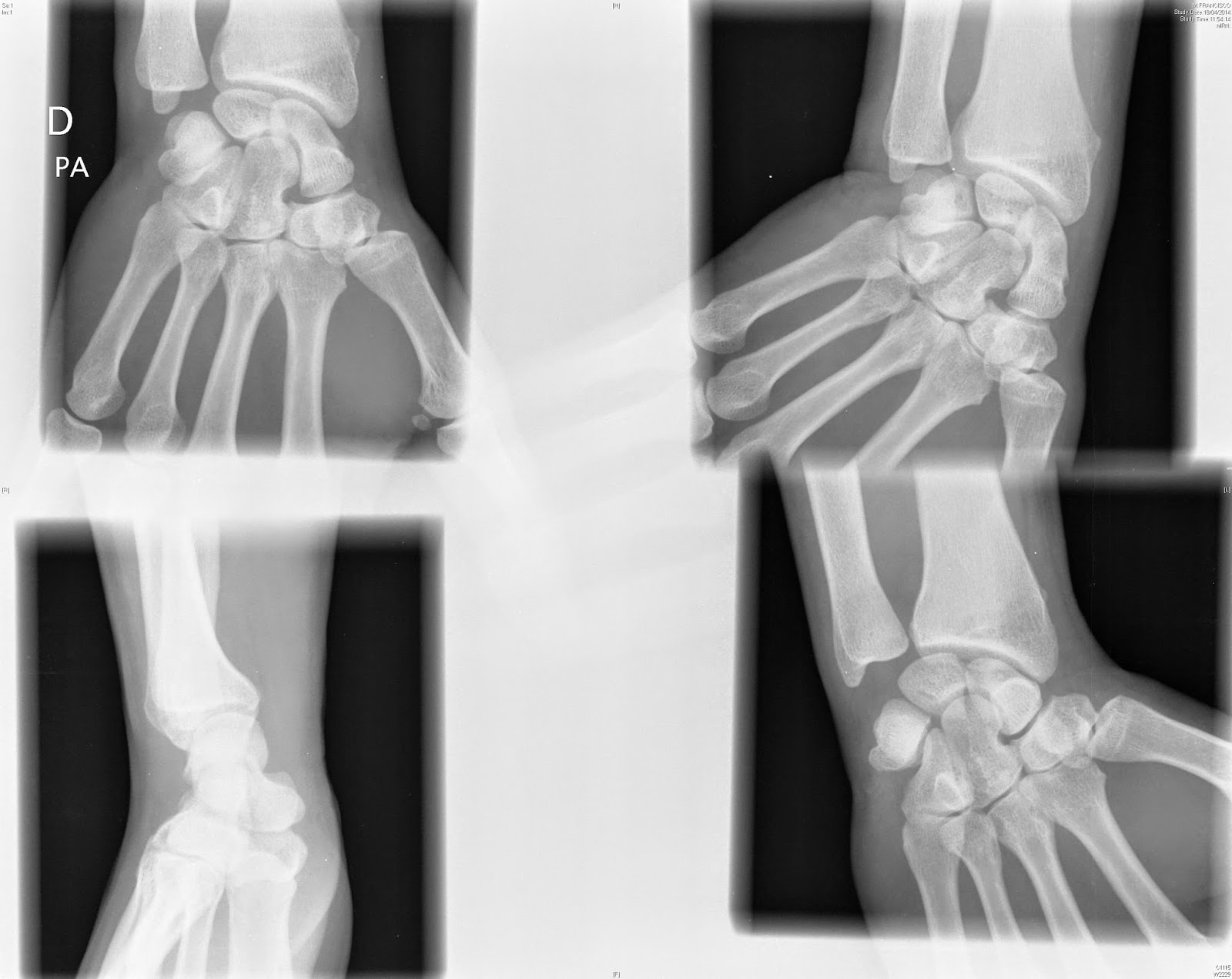 Cirugía de Mano y Traumatología: Pruebas Radiológicas para la fractura ...