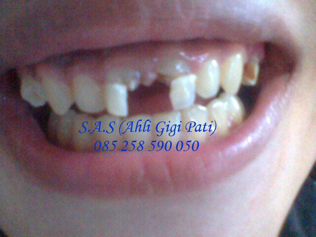 S.A.S - AHLI GIGI KOTA PATI, Jateng & KOTA JEMBER, Jatim: Contoh Gigi ...