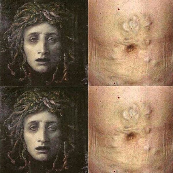 EXAMS AND ME : Caput Medusae