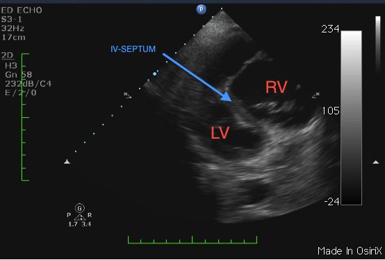 Right Heart Strain ~ Ultrasound Cases Info