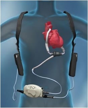 LVAD & Kidney Dysfunction: The Chicken & the Egg - Renal Fellow Network