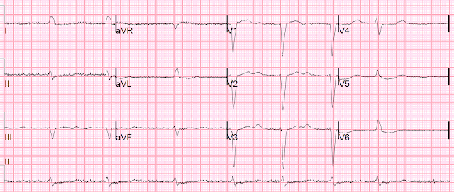 Dr. Smith's ECG Blog: Pre-existing Left Bundle Branch Block and Atrial ...