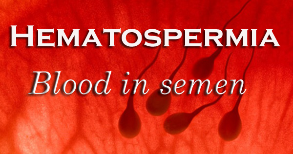 How to get rid of Hematospermia | Men sexual clinic - How to Treat Men ...