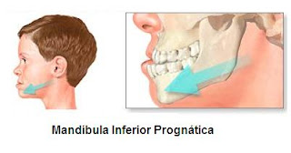 O Prognatismo da minha filha: O que é Prognatismo Mandibular