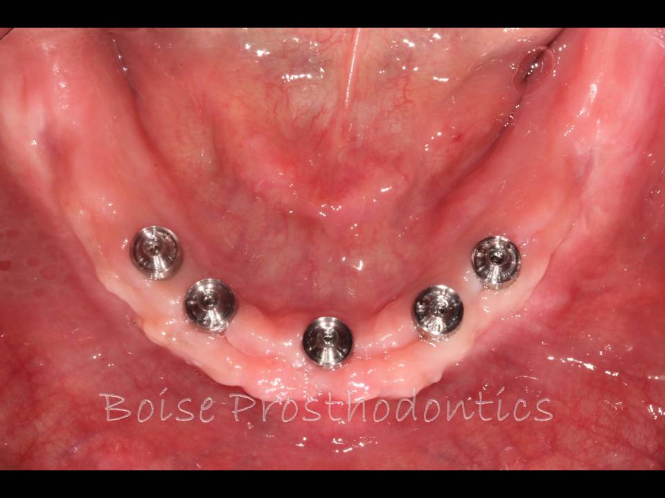 Boise Idaho Prosthodontics: Picture Sequence of Maxillary Complete ...
