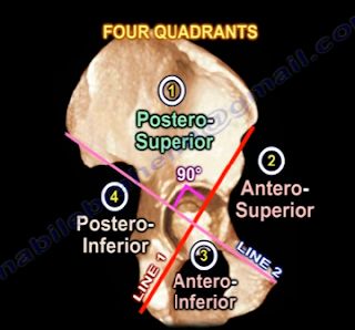 Dr. Nabil Ebraheim's Blogspot: Total Hip Acetabular Screw Placement
