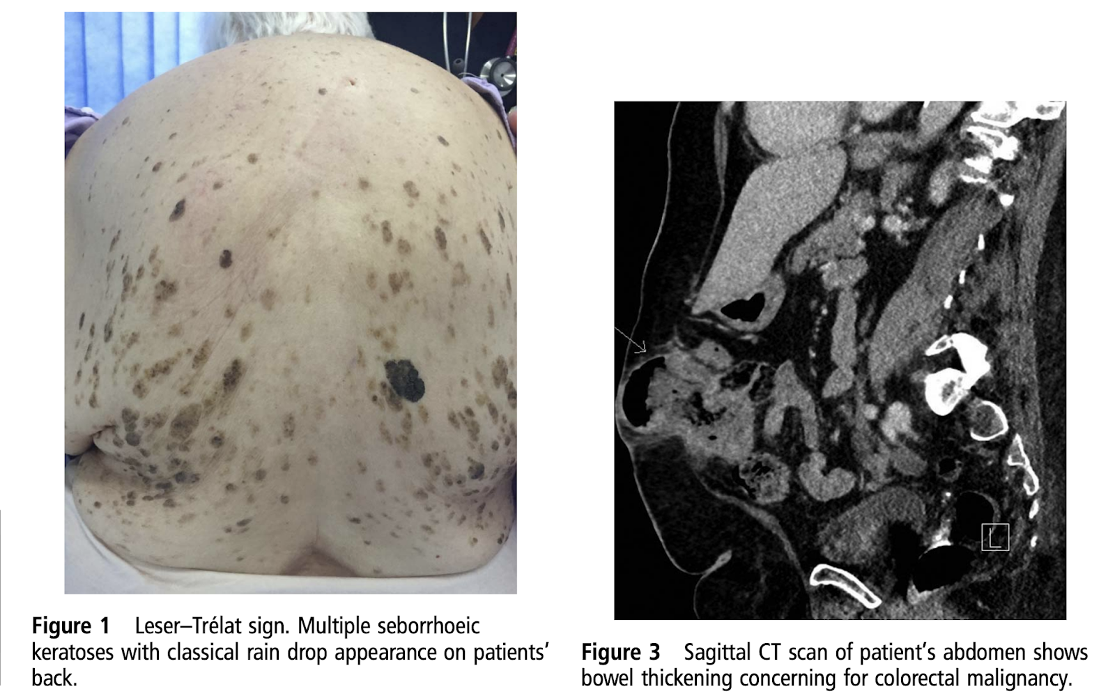 松下 ER ランチ・カンファレンス: レーザー・トレラ徴候 Leser-Trélat sign