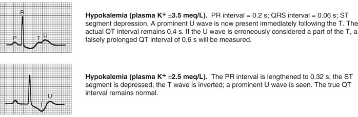 Hypokalemia - ECG changes ~ Medicine Hack