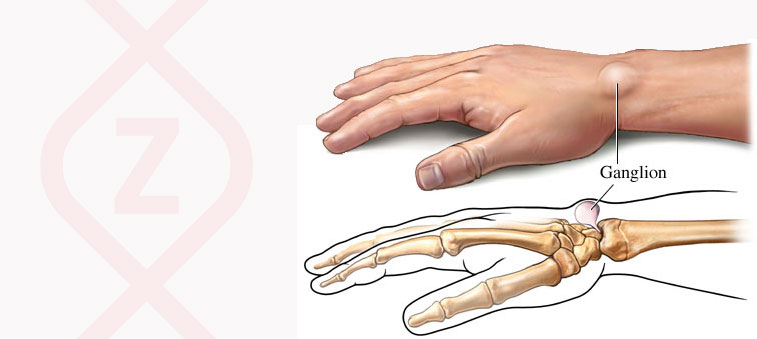 Blogul 5 din palmaresul Vienelei: Chist sinovial