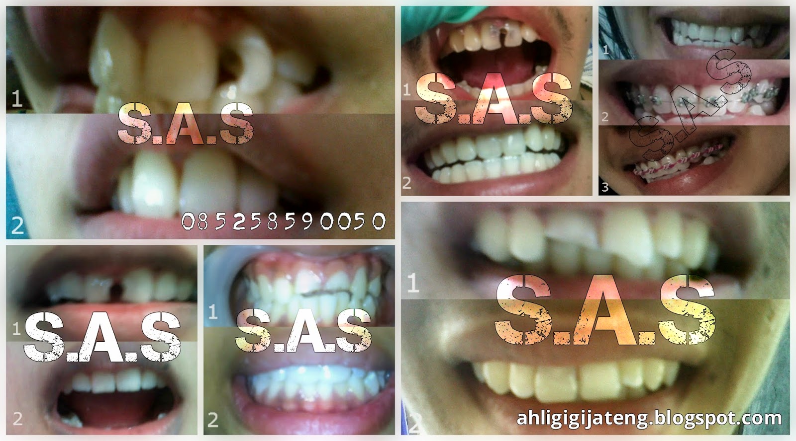 Foto Gigi Palsu Lepas Pasang (Ahli Gigi S.A.S Jember) | S.A.S Dental