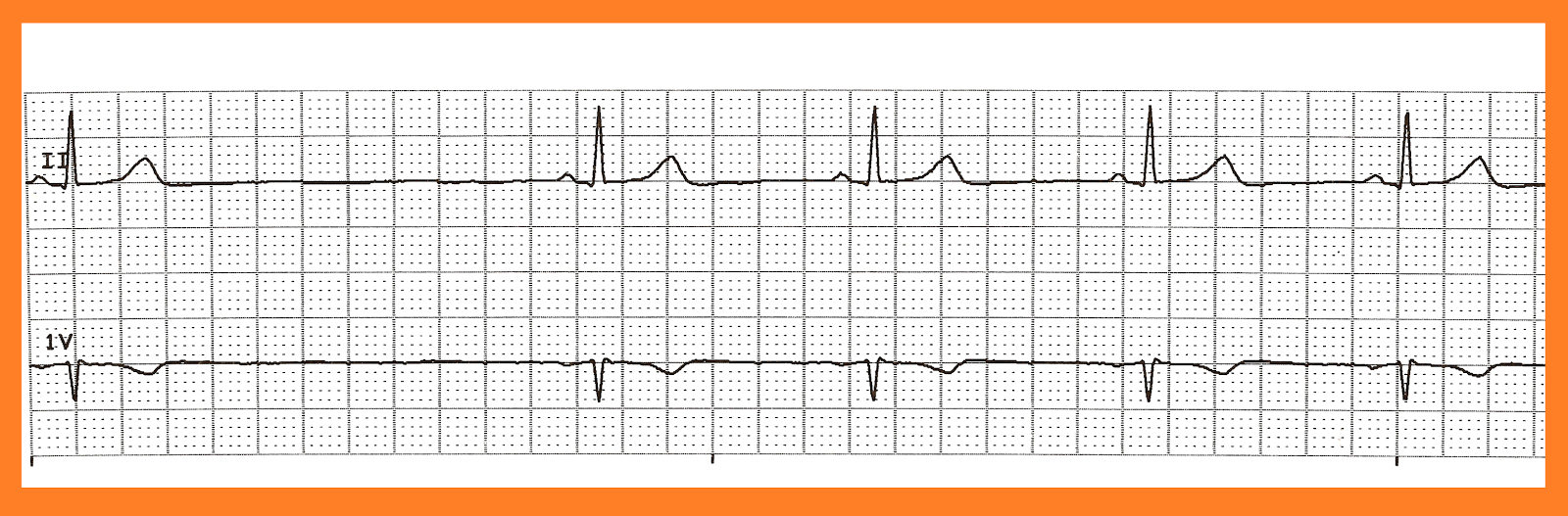 Various Sinus Arrests and Sinus Pauses