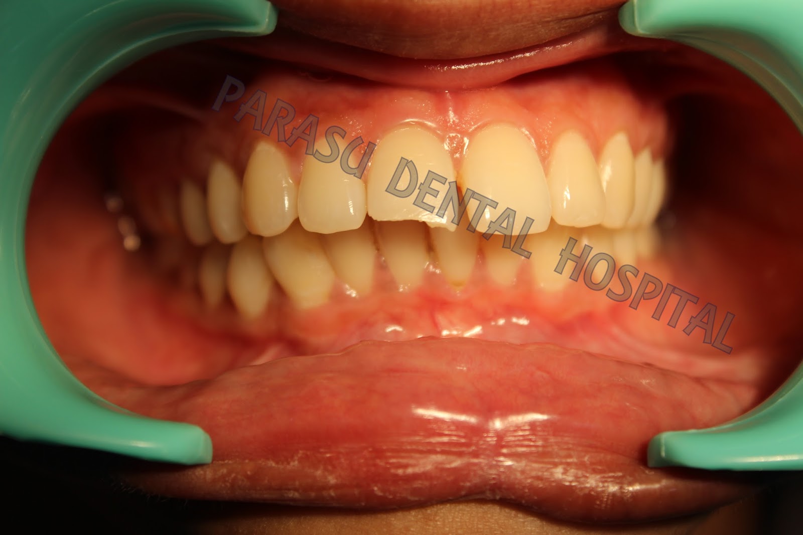 Dental Xray center in medavakkam: Broken front tooth filled with tooth ...