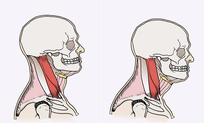 Correcting the Forward Head Fault