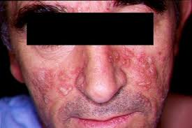 Cuales Son Los Tratamientos Contra La Psoriasis Facial?